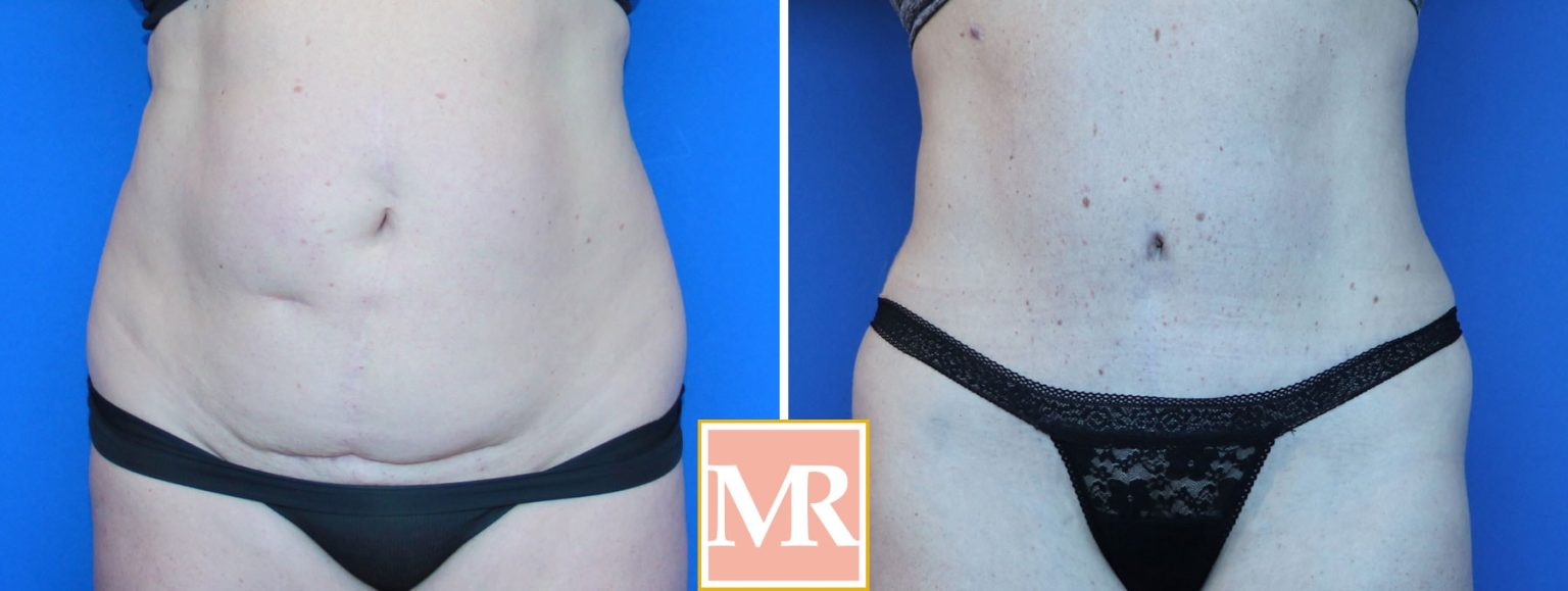 The Benefits of Undergoing a Tummy Tuck with Muscle Repair - Muscle Repair Tummy Tuck